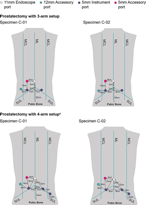 Port Placements For Prostatectomy Using Either A 3‐arm Or 4‐arm Bsu