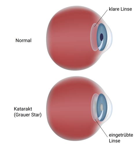 Grauer Star Katarakt 6 häufige Symptome frühzeitig erkennen