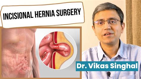 Incisional Hernia Surgery Best Treatment Of Incisional Hernia In