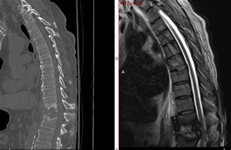 Thoracic Corpectomy Joshua Li Md Phd