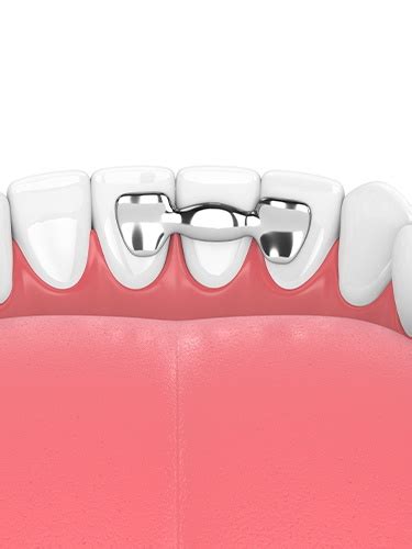 Retainers Orthodontic Appliances Retainers Chicago Orthodontist Chicago