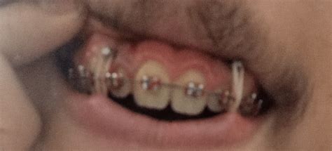 Is This Normal Rbraces