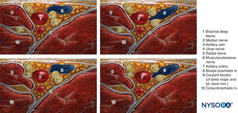 Axillary Block Ultrasound