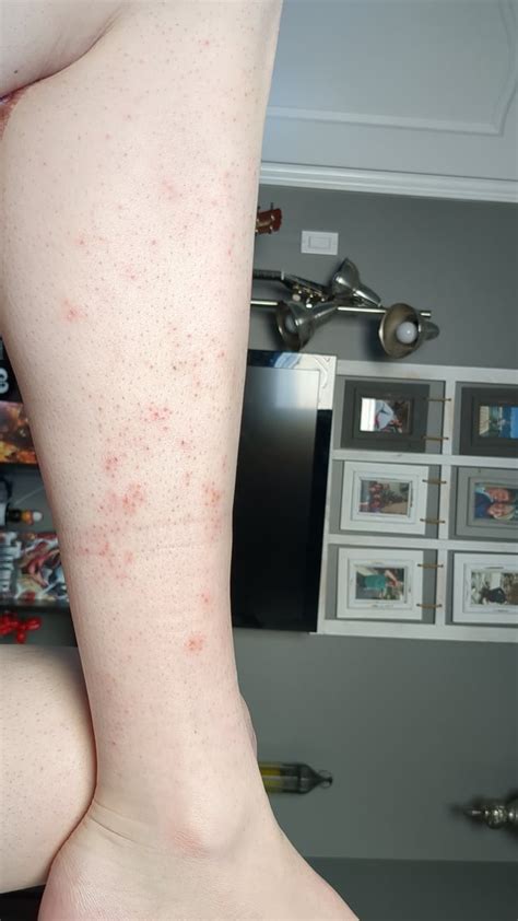 Quick Spreading Rash On My Leg Any Ideas Rmedical