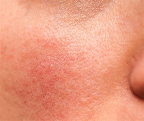 Couperose Skin Vs Rosacea Whats The Difference 𝗠𝘂𝗸𝘁𝗶 𝗢𝗿𝗴𝗮𝗻𝗶𝗰𝘀 𝗨𝗦𝗔