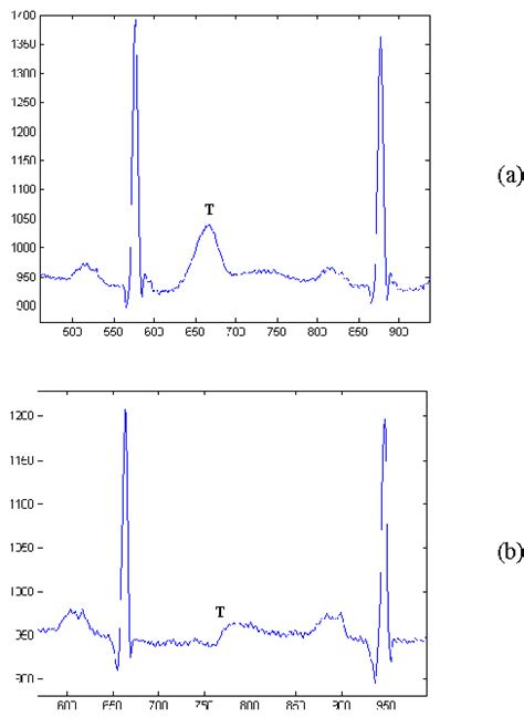 figure 1 from a semi automated qt interval measurement based on wavelet