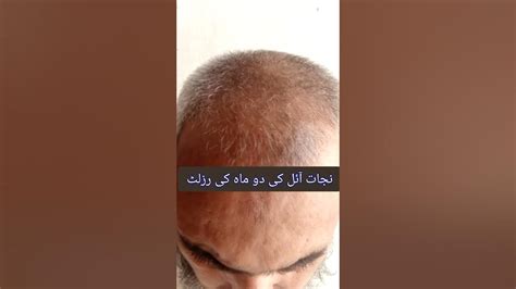 دنیا بھر میں کامیاب بال أکانے والا آئل بالوں کو لمبا گھنا چمکدار اور