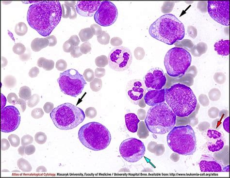 Acute Myeloid Leukaemia With T 8 21 Q22 Q22 RUNX RUNX1T1 CELL