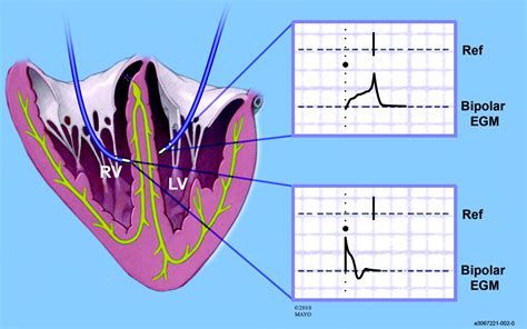 Teaching Points With 3 Dimensional Mapping Of Cardiac Arrhythmias