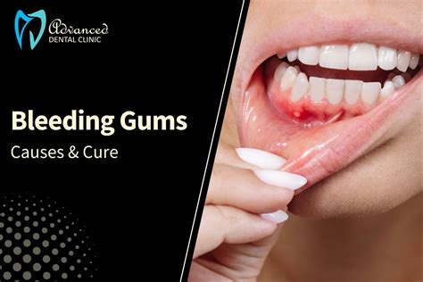 How To Cure Bleeding Gums Advanced Dental Clinic East Delhi