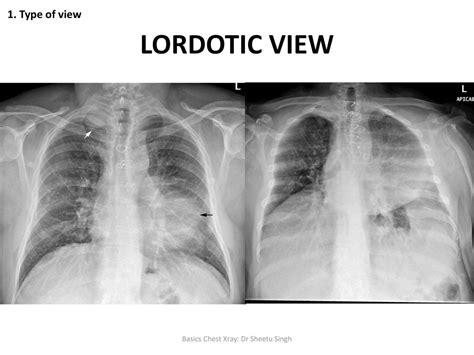 Basics Of Chest X Ray Dr Sheetu Singh Assistant Professor Ppt Download
