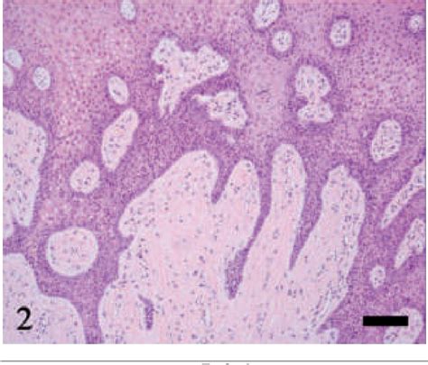 Acanthomatous Ameloblastoma Semantic Scholar