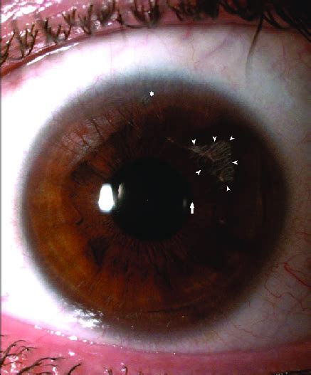 Slit Lamp Photography Of The Left Eye 18 Months Postvitrectomy Showing