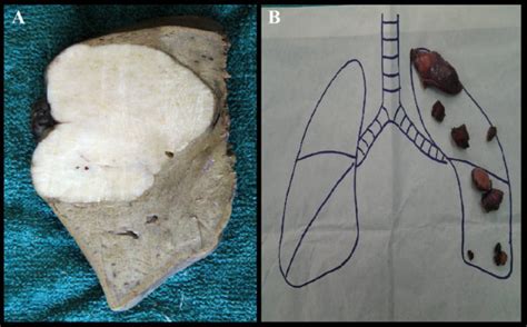 A Cut Section Of Right Hepatectomy Showing Greyish White Tumour 9 8 ×
