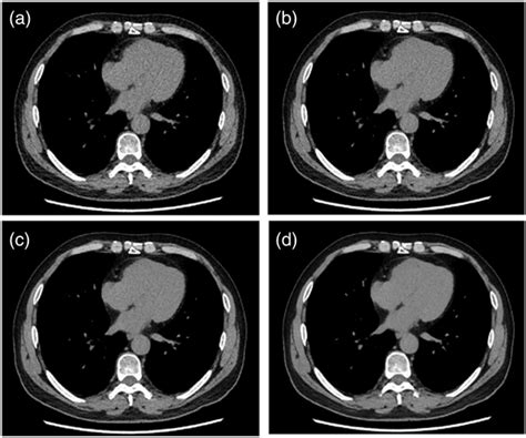A 66‐year‐old Male A Axial Ct Image Reconstructed With Adaptive