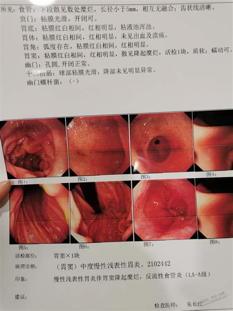胃镜报告 线报酷