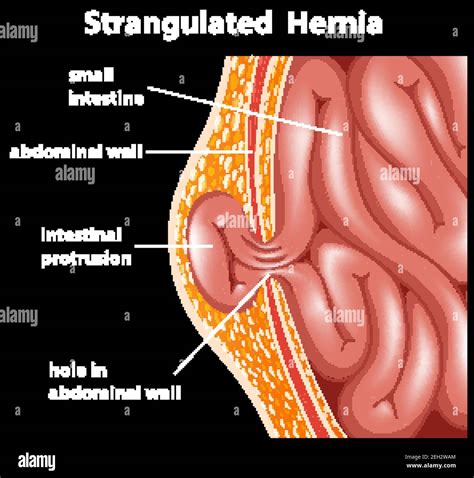 Strangulated Hernia Anatomy Diagram Illustration Stock Vector Image