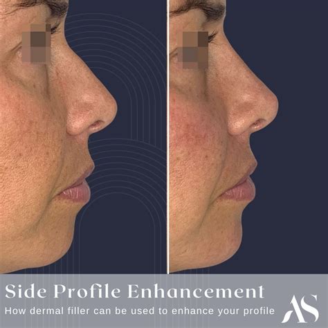 Side Profile Enhancement Purpose Improve The Definition Shape And