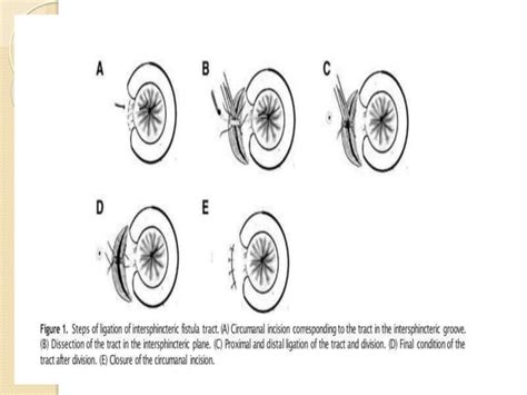 Ligation Of Intersphincteric Fistulous Tract Vs Endorectal Advancement Pptx