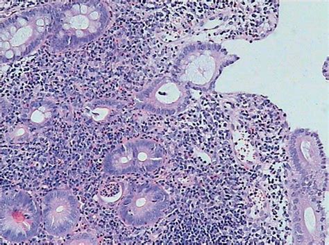 Severe Viral Oesophagitis Pharyngitis And Stomatitis As Antecedents