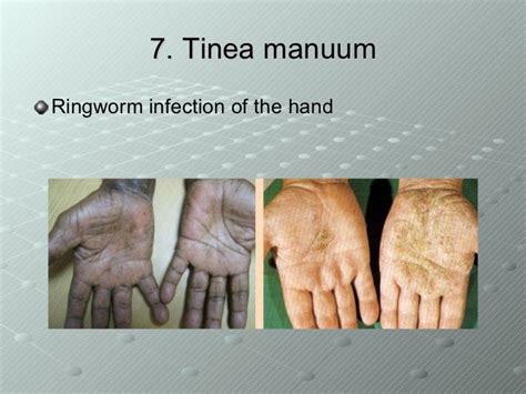 Tinea Dermatophytes