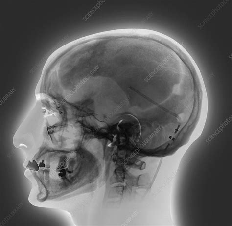Ventricular Shunt X Ray Stock Image C015 5114 Science Photo Library