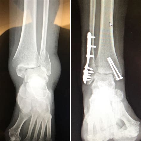 Tibia And Fibula Surgery Memberukraine