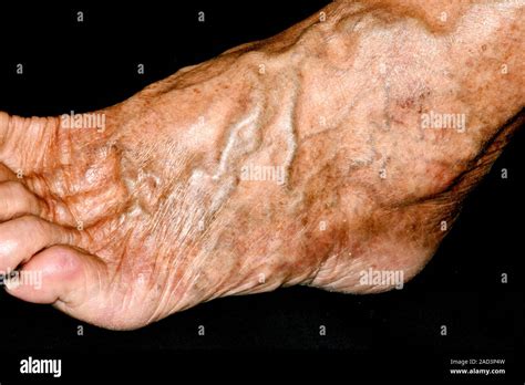 Varicose Veins Close Up Of Varicose Veins On The Foot Of A 73 Year Old