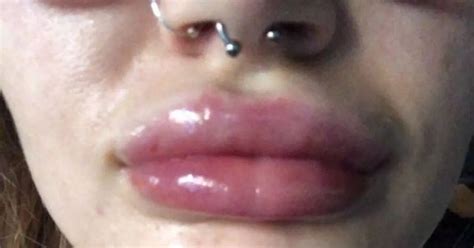 Woman Complains About Botched Lip Fillers And Is Stunned By Beauty
