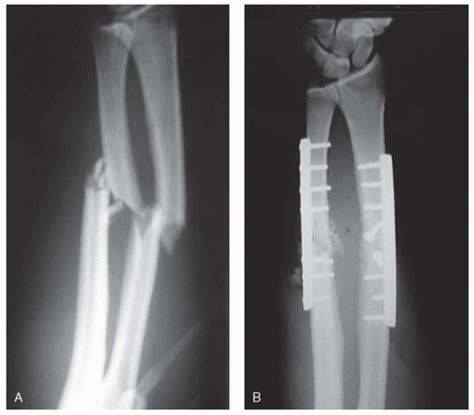 Open Reduction And Internal Fixation Of Forearm Fractures Musculoskeletal Key