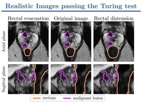 Data Augmentation Mri Medical Imaging Medical Image Computing