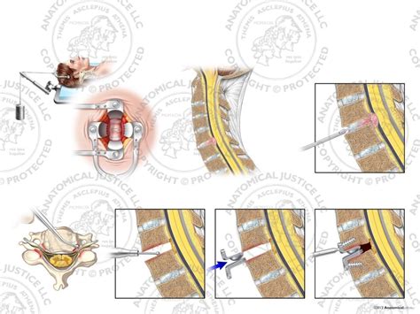 Female C5 6 Anterior Cervical Discectomy Utilizing Traction And Total