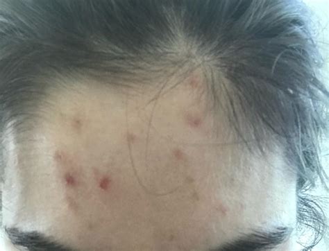 For Those With Staph Aureus Folliculitis Folliculitis