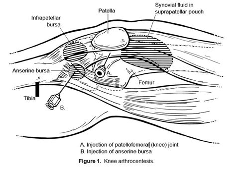 Knee Arthrocentesis Landmarks