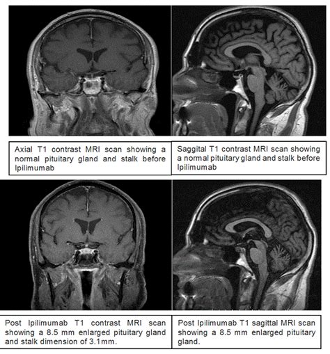 Ipilimumab Causing Autoimmune Hypophysitis A Case Report