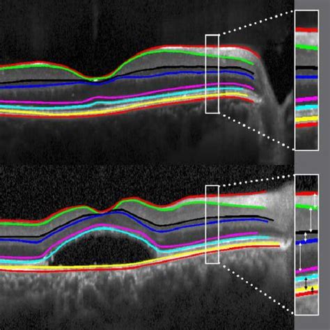 Segmentation Of Retinal Layers Horizontal Sd Oct From A Healthy Download Scientific Diagram