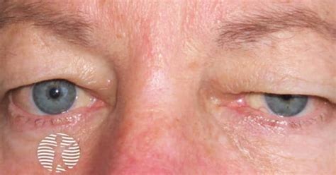 BOTOX Injections Image