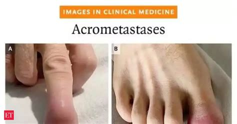 Lung Cancer Spread So Rare It Devoured Bones In Mans Fingers And Toes