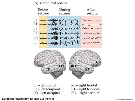 Eeg Brain Activity Chart