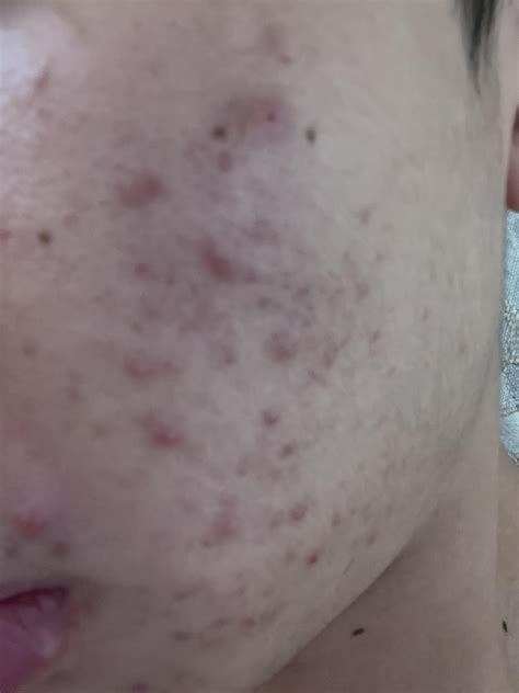 Acne Type Identifyingways Of Preventing Scarring Racnetreatments