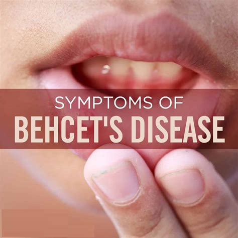 Behcets Disease Symptoms Causes And Treatment Options