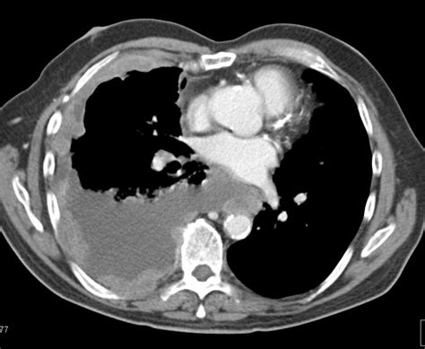 Mesothelioma Right Pleural Space Chest Case Studies Ctisus Ct Scanning