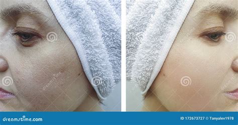 Woman Face Wrinkles Before After Difference Effect Cosmetology Plastic
