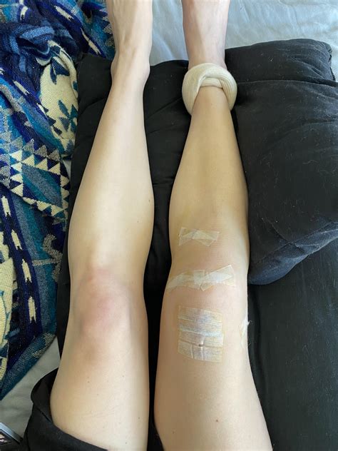 2 Weeks Post Op R Acl