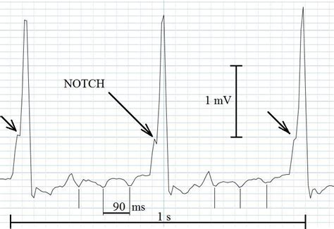 Atrial Fibrillation With A Dominant Frequency Of Approx 650