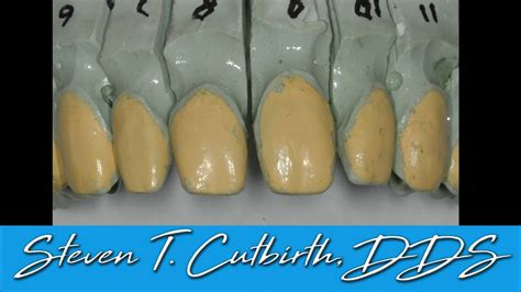 Why You Should Prep The Interproximal Wrap Veneers Youtube