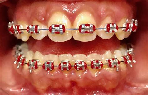 Pin By Dental Norte Concepcion On Ortodoncia Braces Colors Dental