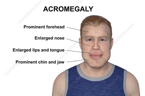 Acromegaly In A Man Illustration Stock Image F0418317 Science