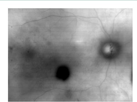 Figure 1 From Prevalence Of Choroidal Nevi In Patients With Central Serous Chorioretinopathy