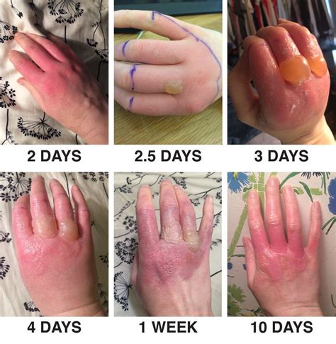 Photodermatitis Medizzy